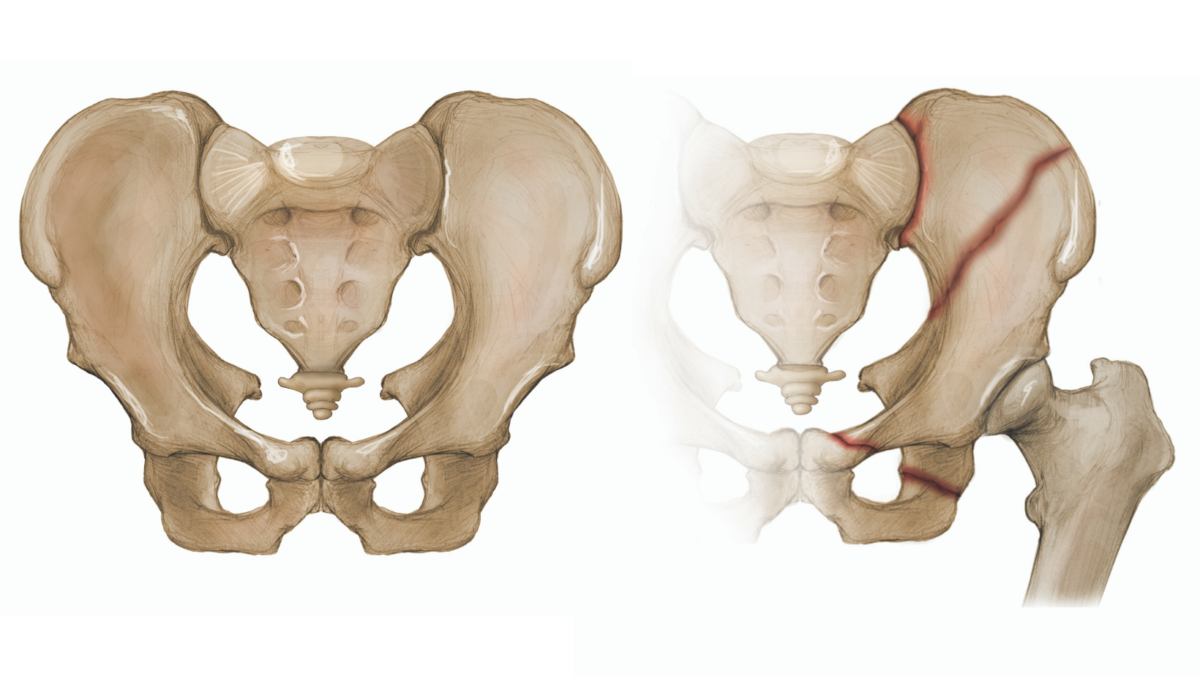 Pelvic Fracture