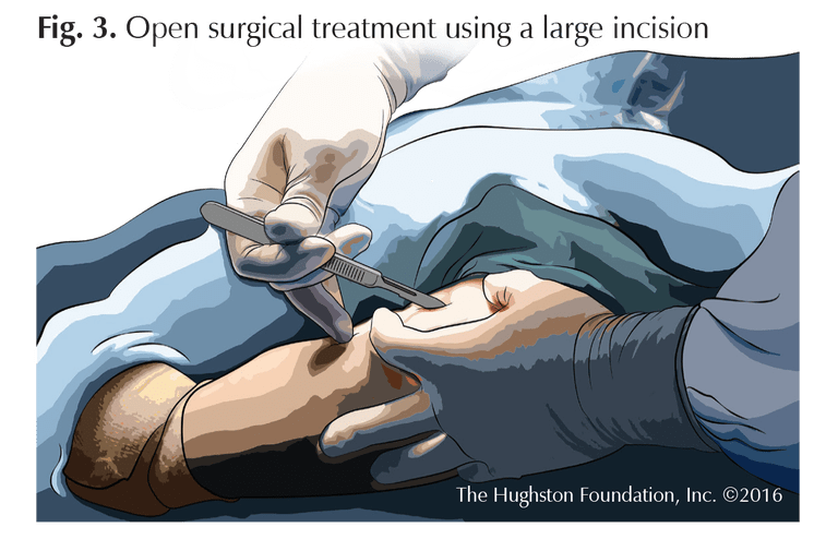 Taming Tennis Elbow - Hughston Clinic