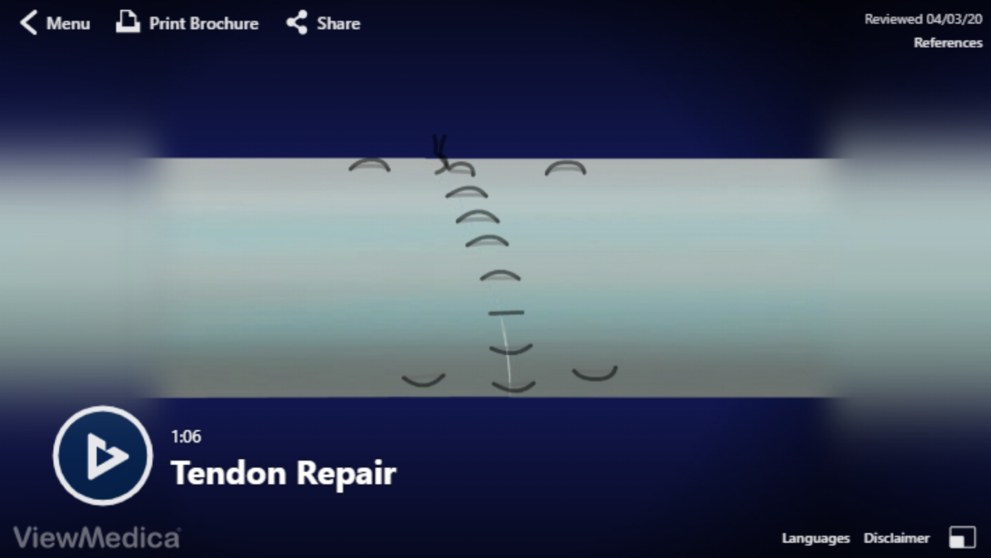 Video: Tendon Repair - Hughston Clinic