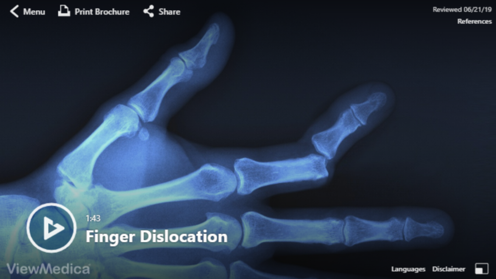Video: Finger Dislocation - Hughston Clinic