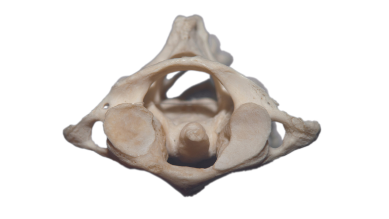 Odontoid Fractures - Hughston Clinic