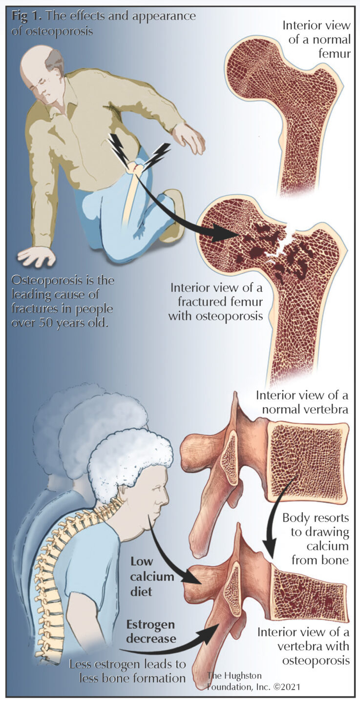 Osteoporosis - Hughston Clinic