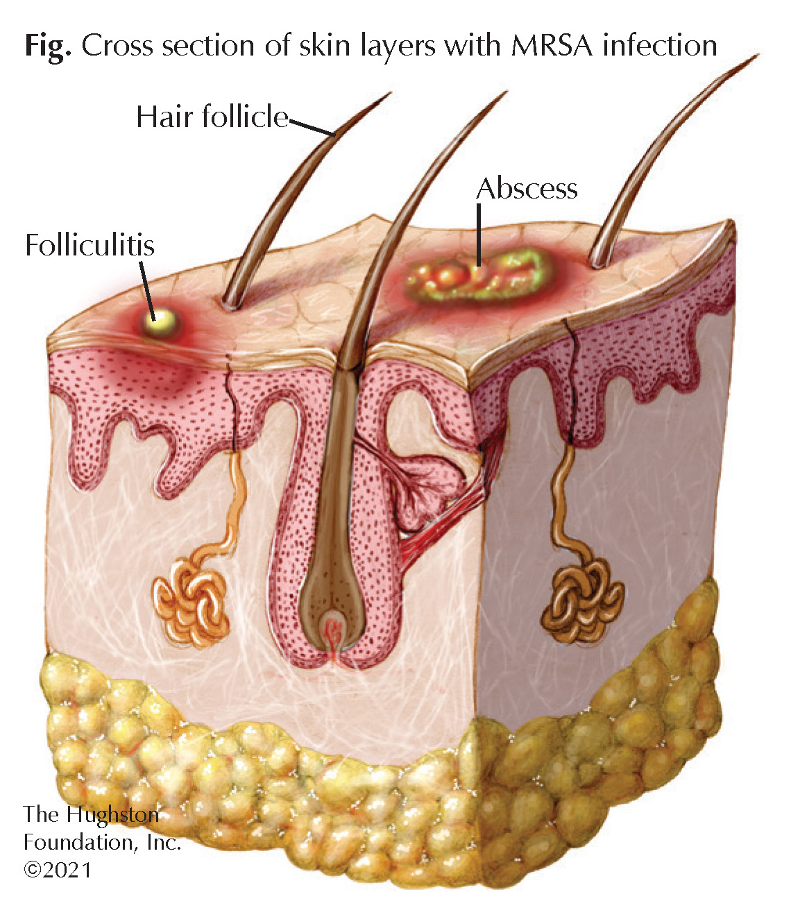 MRSA Infections and Athletes - Hughston Clinic