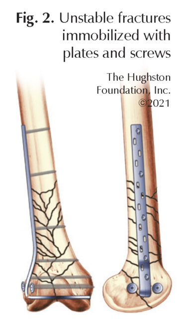 Caring for Your Fracture - Hughston Clinic