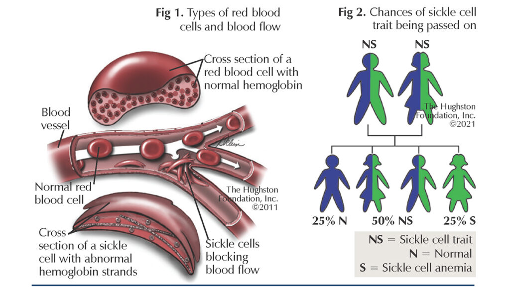 Sickle Cell Trait in Sports - Hughston Clinic