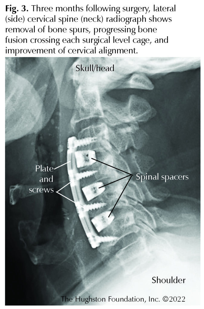 Cervical Neck Fusion Cervical Neck Fusion