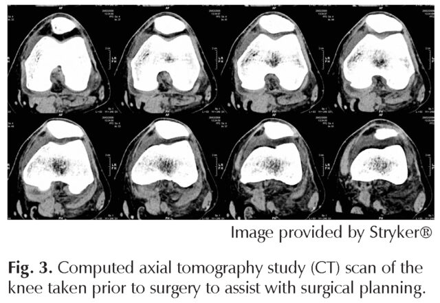 Robotic Total Knee Replacement: Questions for a Specialist - Hughston ...