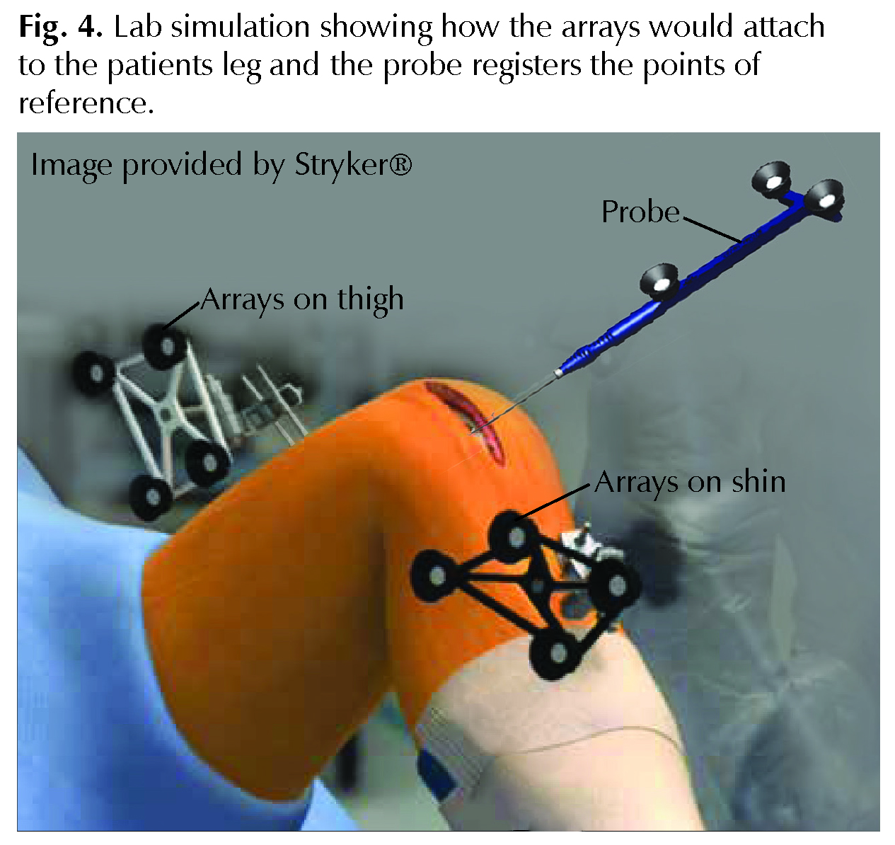 Robotic Total Knee Replacement: Questions for a Specialist - Hughston ...