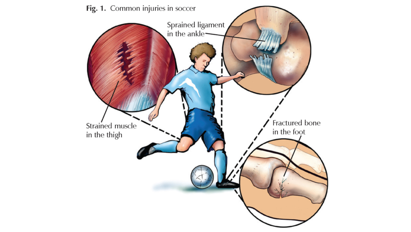 Soccer Players: Sprains, Strains, and Breaks - Hughston Clinic