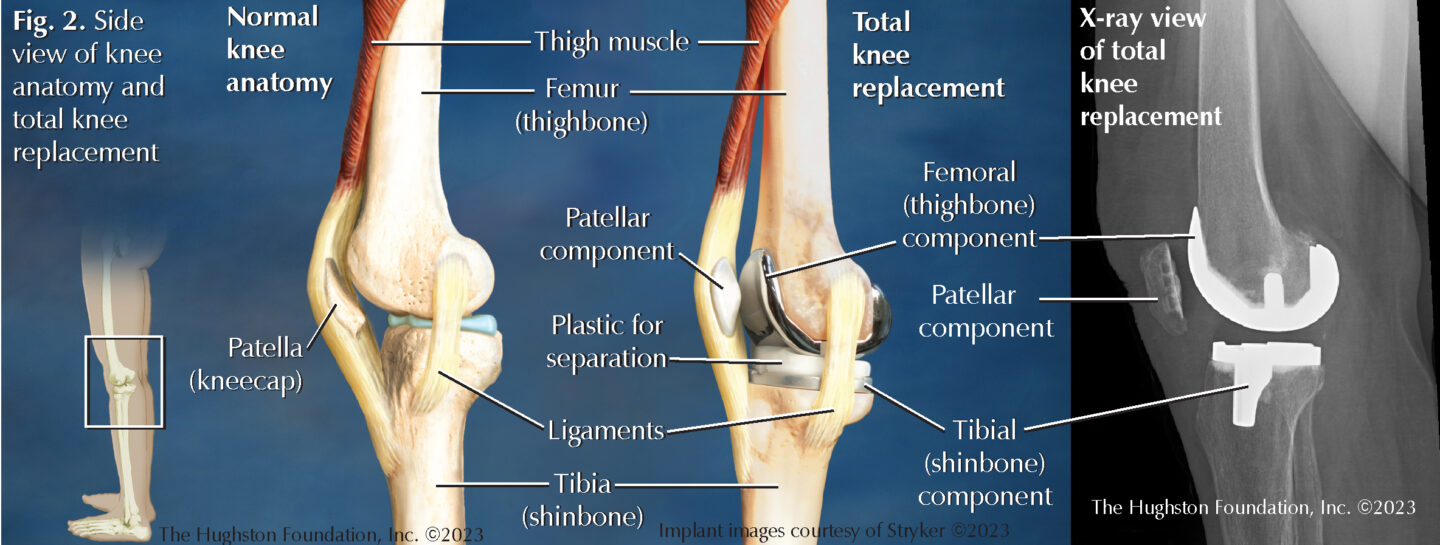 Total Knee Arthroplasty: Questions for a Specialist - Hughston Clinic