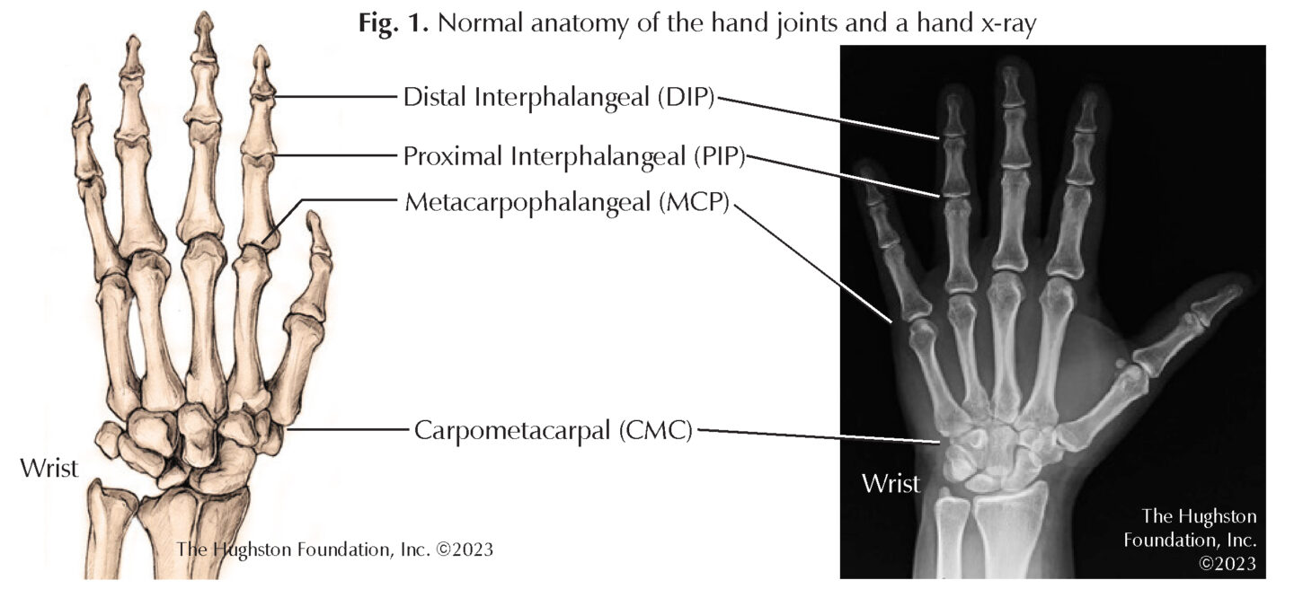 Hand Arthritis - Hughston Clinic