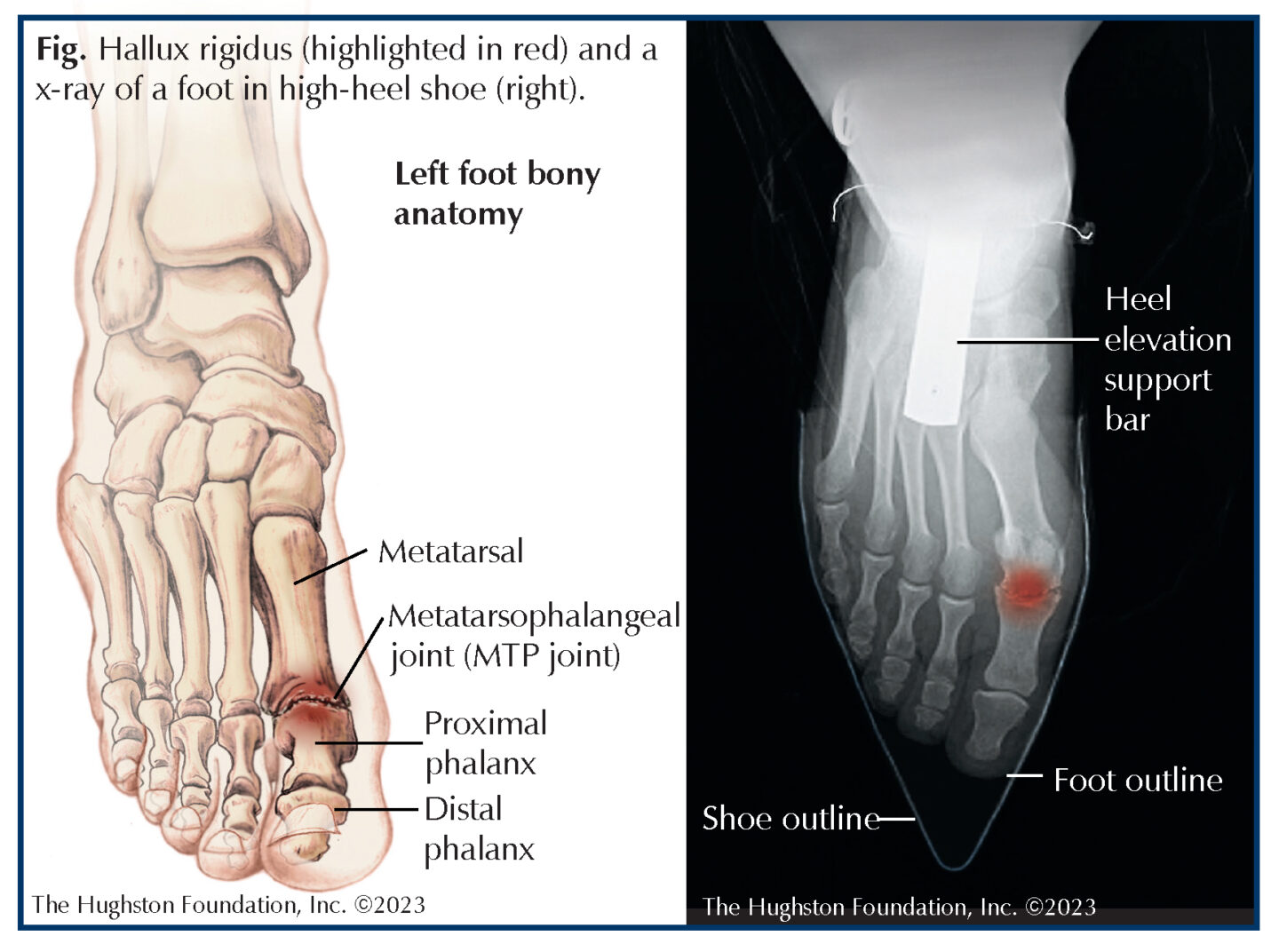 Hallux Rigidus - Hughston Clinic