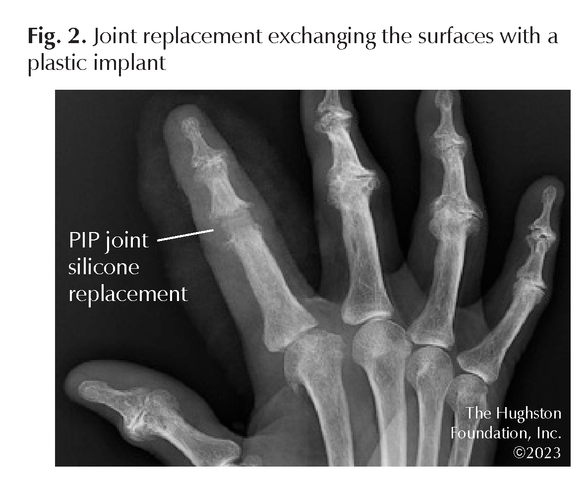 Hand Arthritis - Hughston Clinic