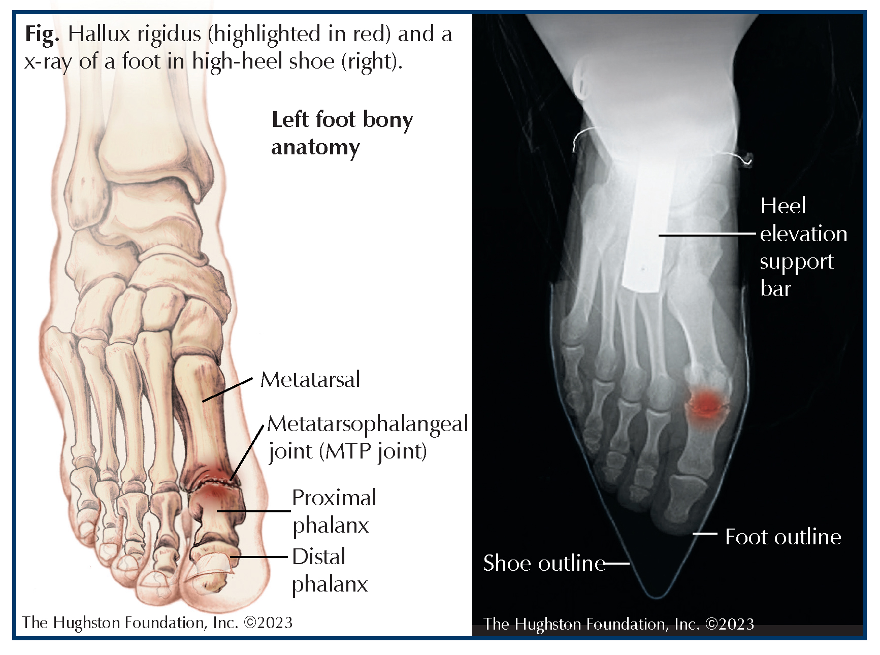 Hallux Rigidus - Hughston Clinic
