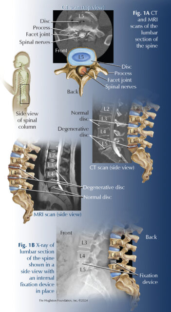 Chronic Low Back Pain - Hughston Clinic