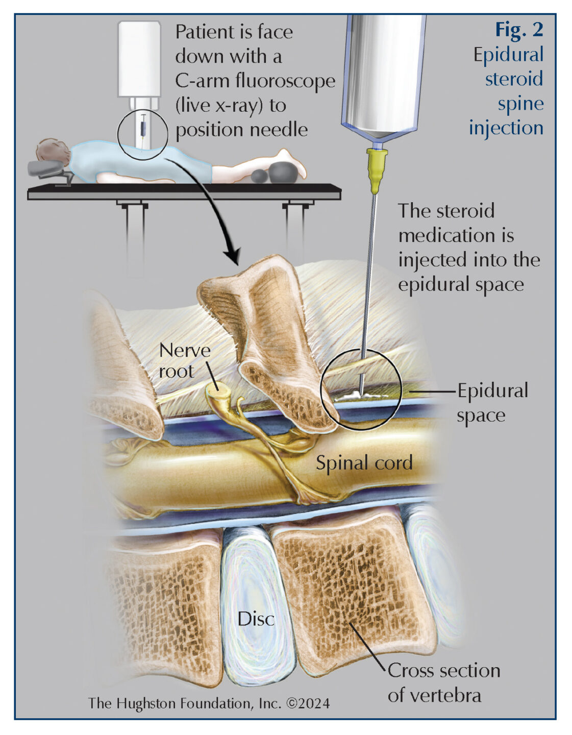 Chronic Low Back Pain - Hughston Clinic