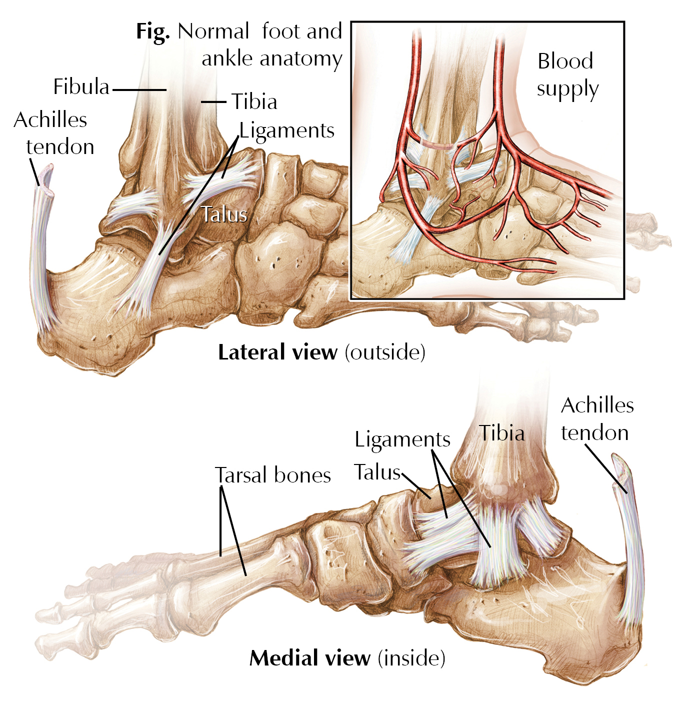 Osteonecrosis of the Foot & Ankle - Hughston Clinic