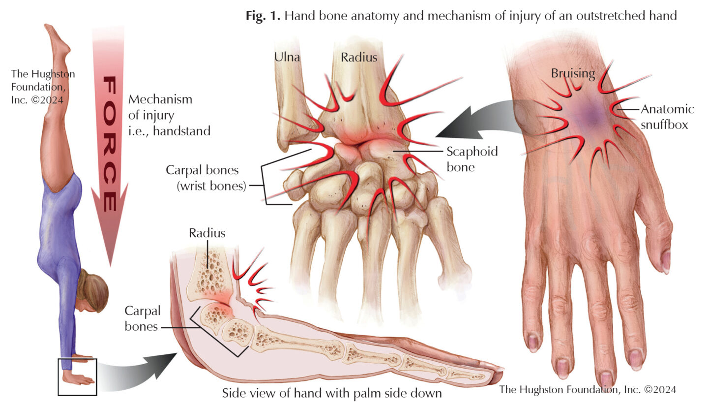 Scaphoid Fractures - Hughston Clinic