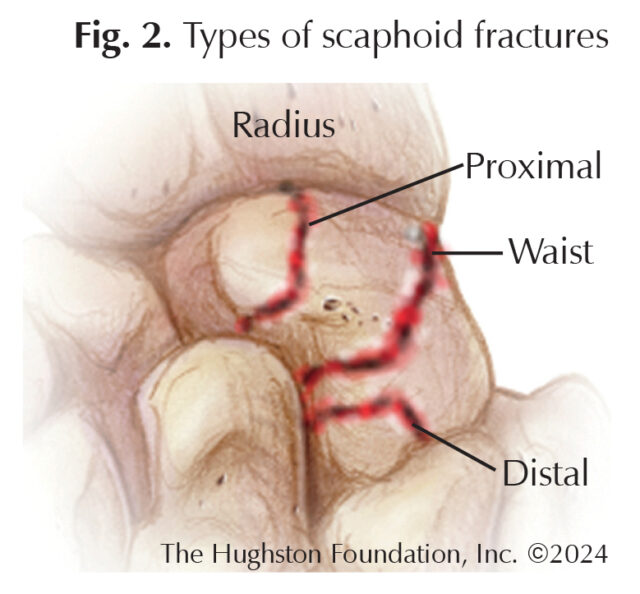 Scaphoid Fractures - Hughston Clinic