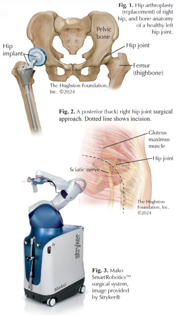 Outpatient Total Joint Arthroplasty - Hughston Clinic