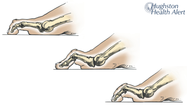 Lesser Toe Deformities Understanding Claw Toe Hammer Toe And Mallet Toe Hughston Clinic