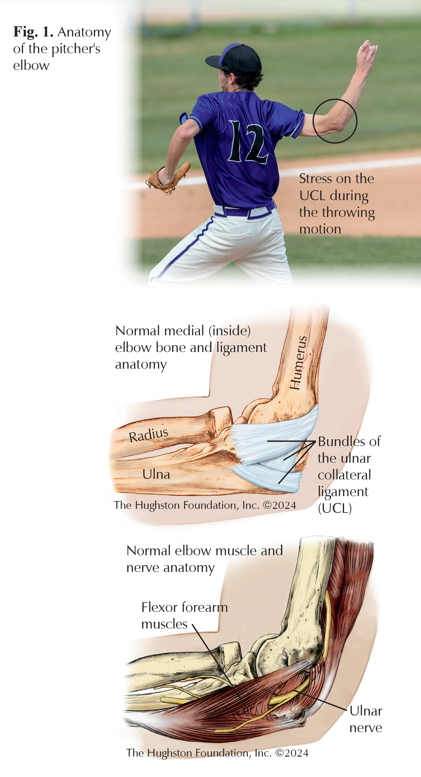 Tommy John Surgery - Hughston Clinic