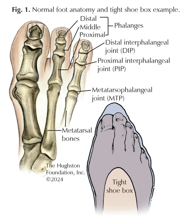 Lesser Toe Deformities Understanding Claw Toe Hammer Toe And Mallet Toe Hughston Clinic