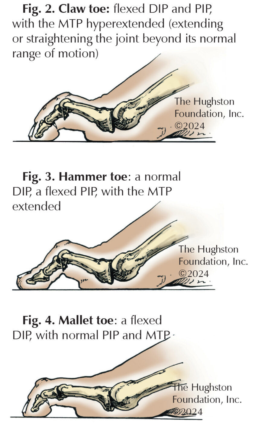 Lesser Toe Deformities: Understanding Claw Toe, Hammer Toe, and Mallet Toe - Hughston Clinic
