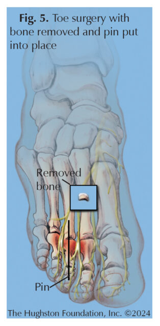 Lesser Toe Deformities: Understanding Claw Toe, Hammer Toe, and Mallet ...