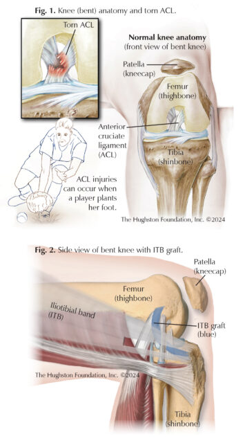 Modified Lemaire Lateral Extra-Articular Tenodesis: Improving ACL ...