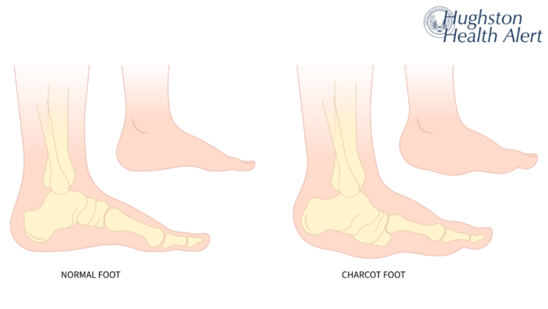 Charcot Joint Disease: A Hidden Consequence of Peripheral Neuropathy ...