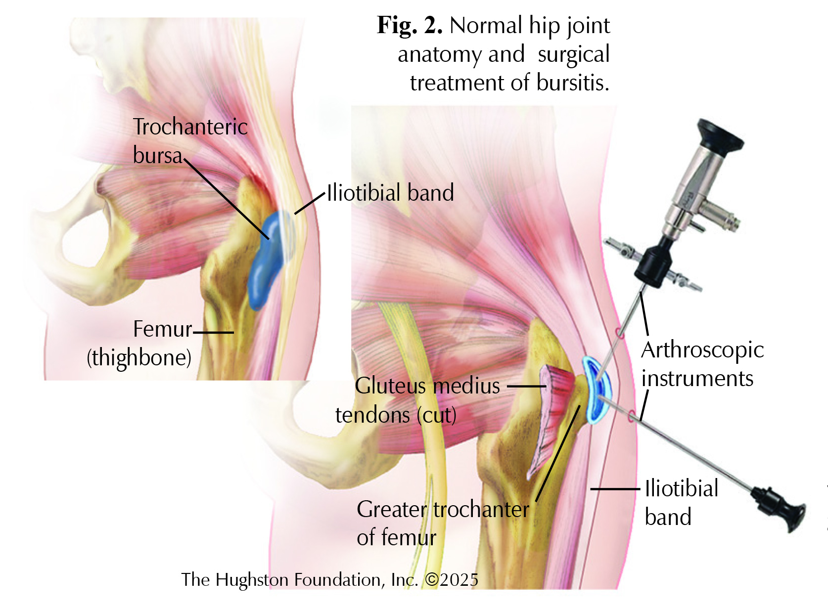 Greater Trochanteric Bursitis and Pain Syndrome - Hughston Clinic