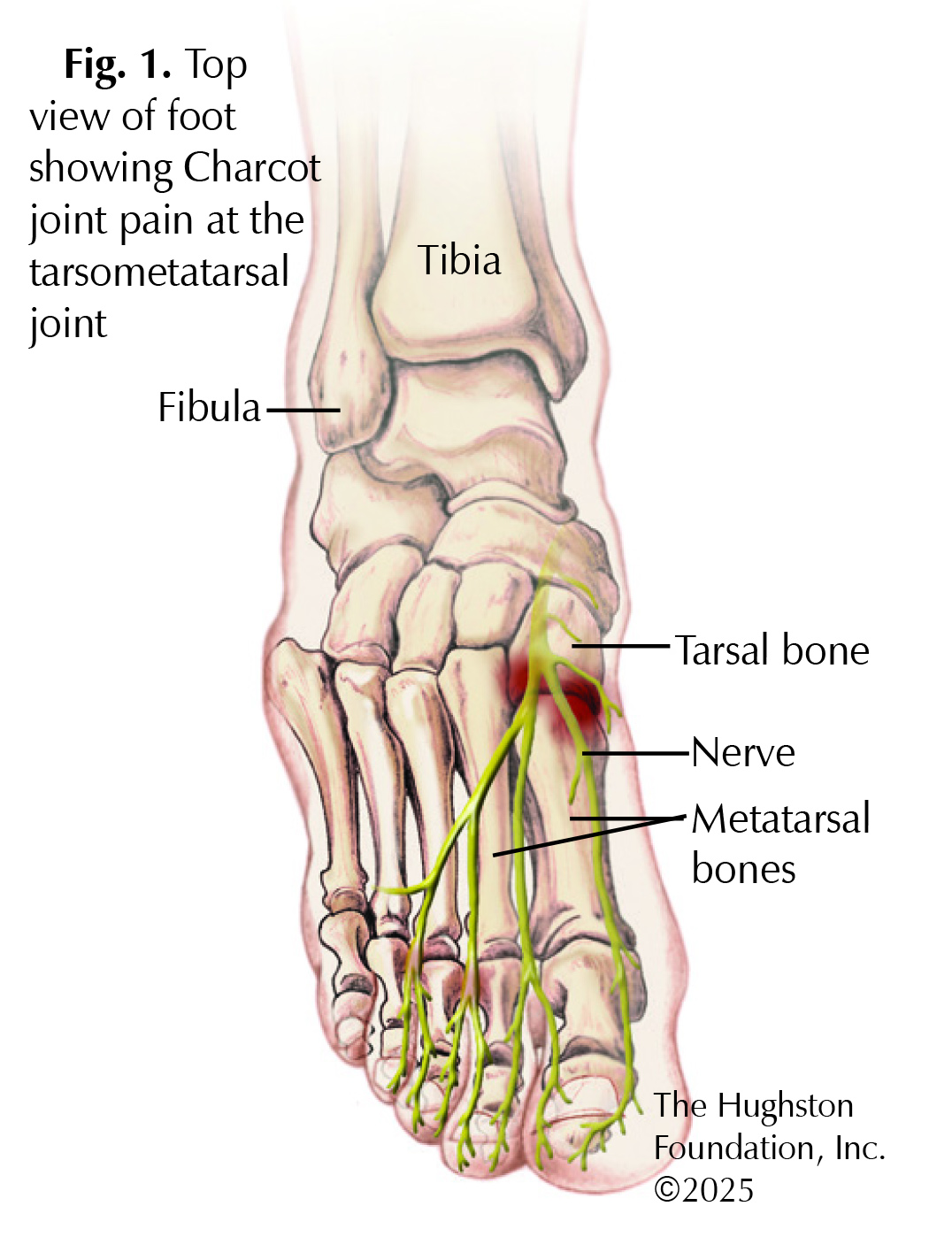 Charcot Joint Disease: A Hidden Consequence of Peripheral Neuropathy ...