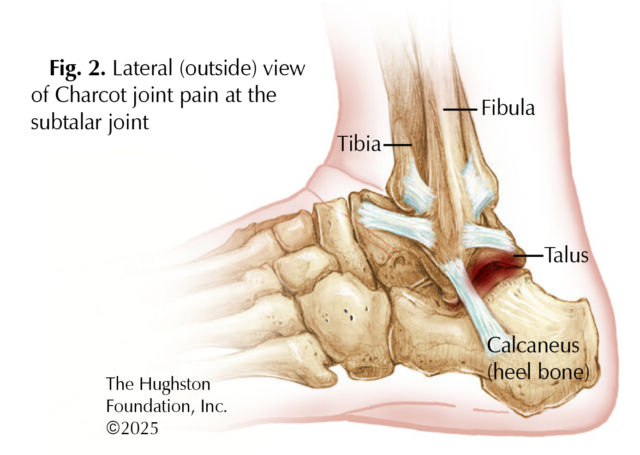 Charcot Joint Disease: A Hidden Consequence of Peripheral Neuropathy ...
