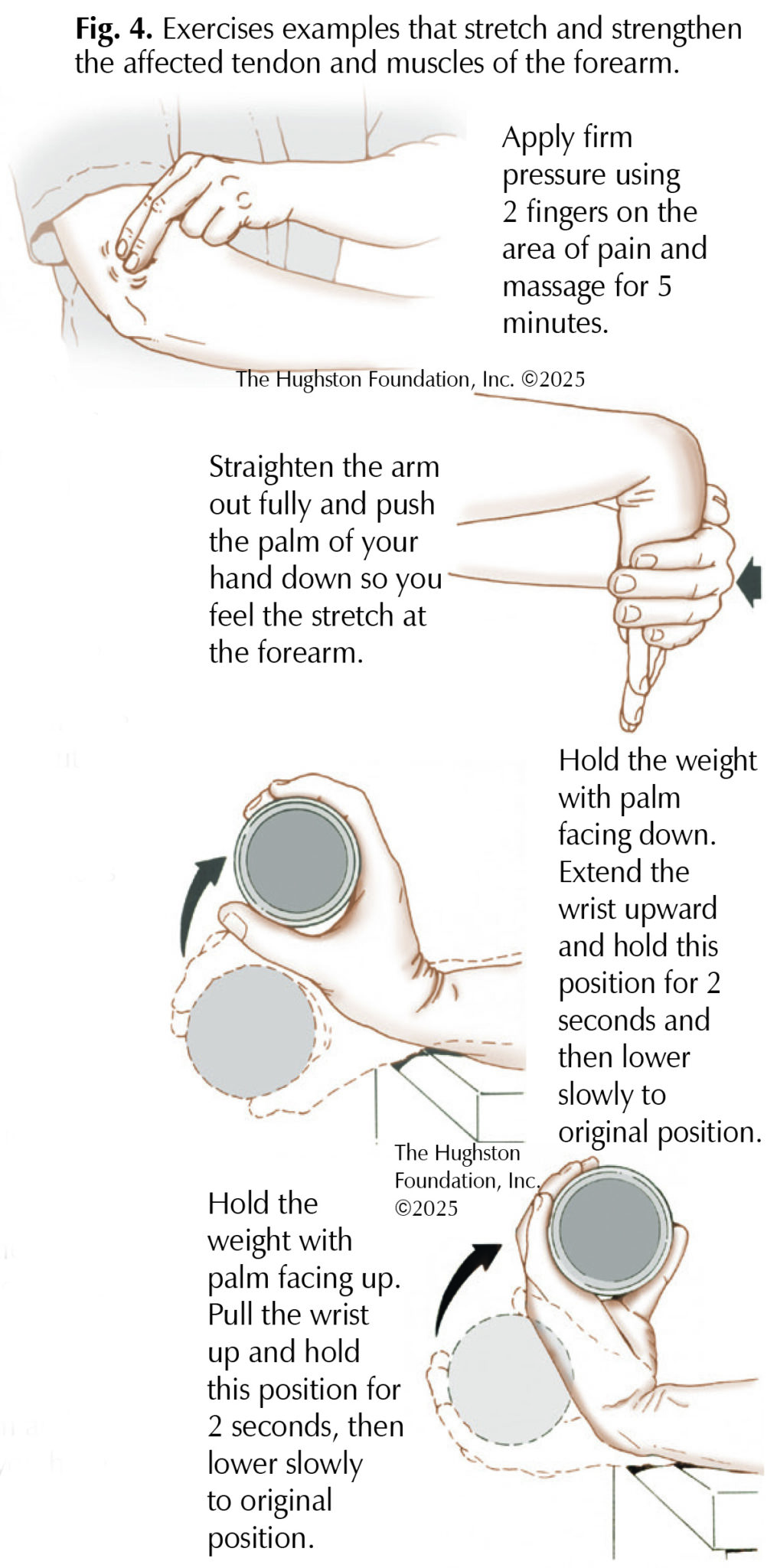 Lateral Epicondylitis - Tennis Elbow - Hughston Clinic