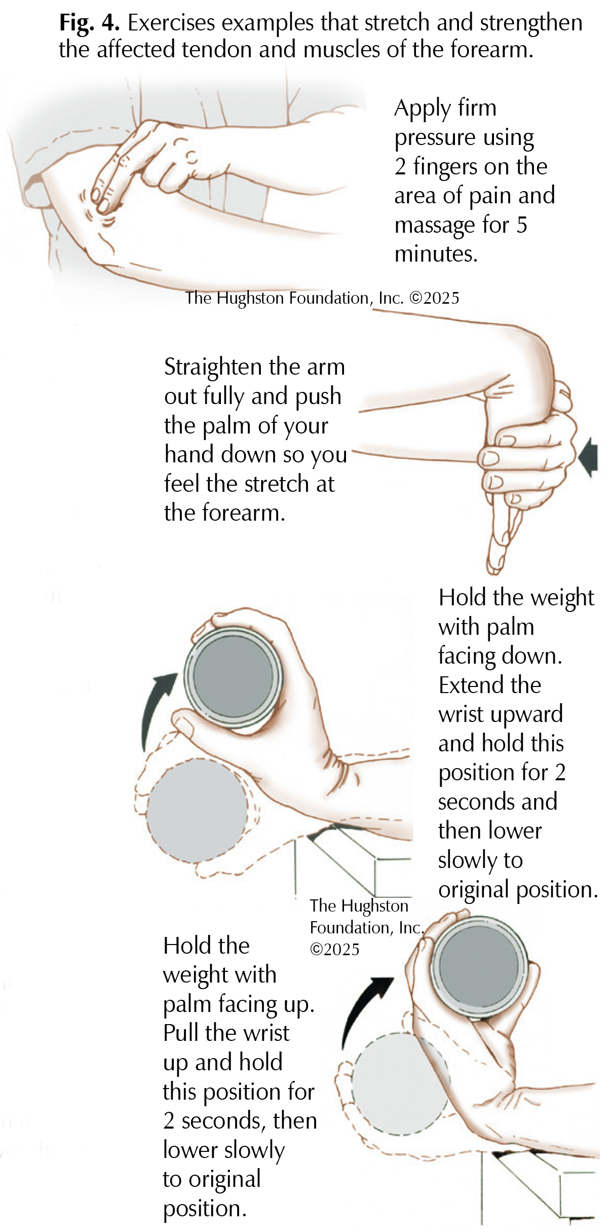 Lateral Epicondylitis Tennis Elbow Hughston Clinic
