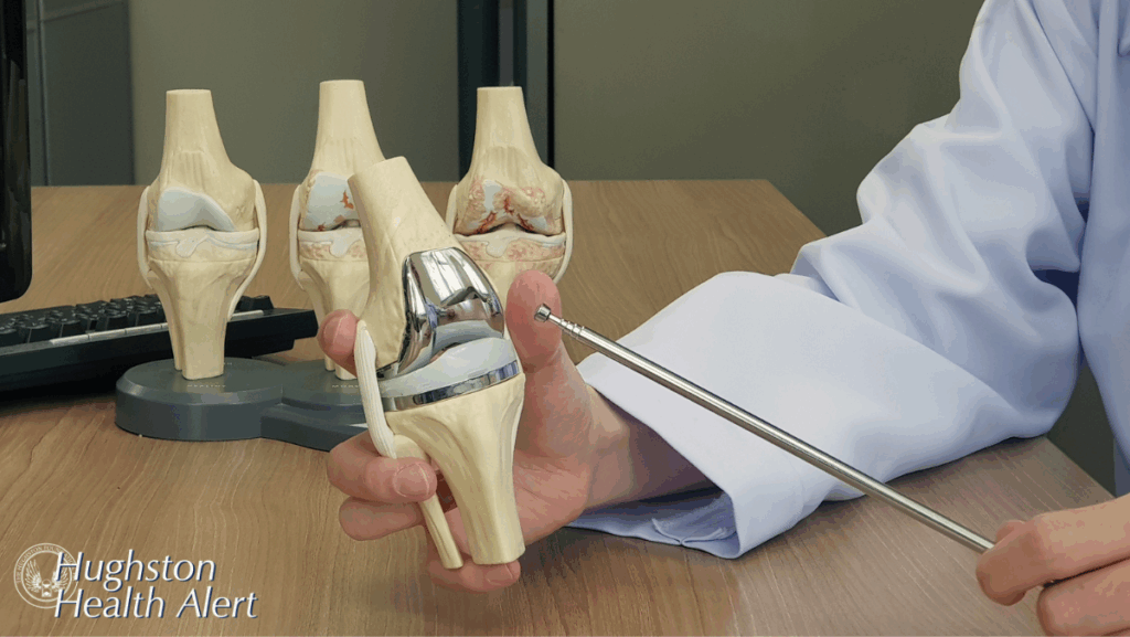 Total Knee Replacement - Hughston Clinic