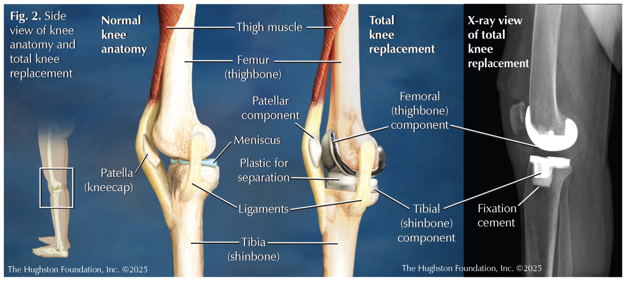 Total Knee Replacement - Hughston Clinic