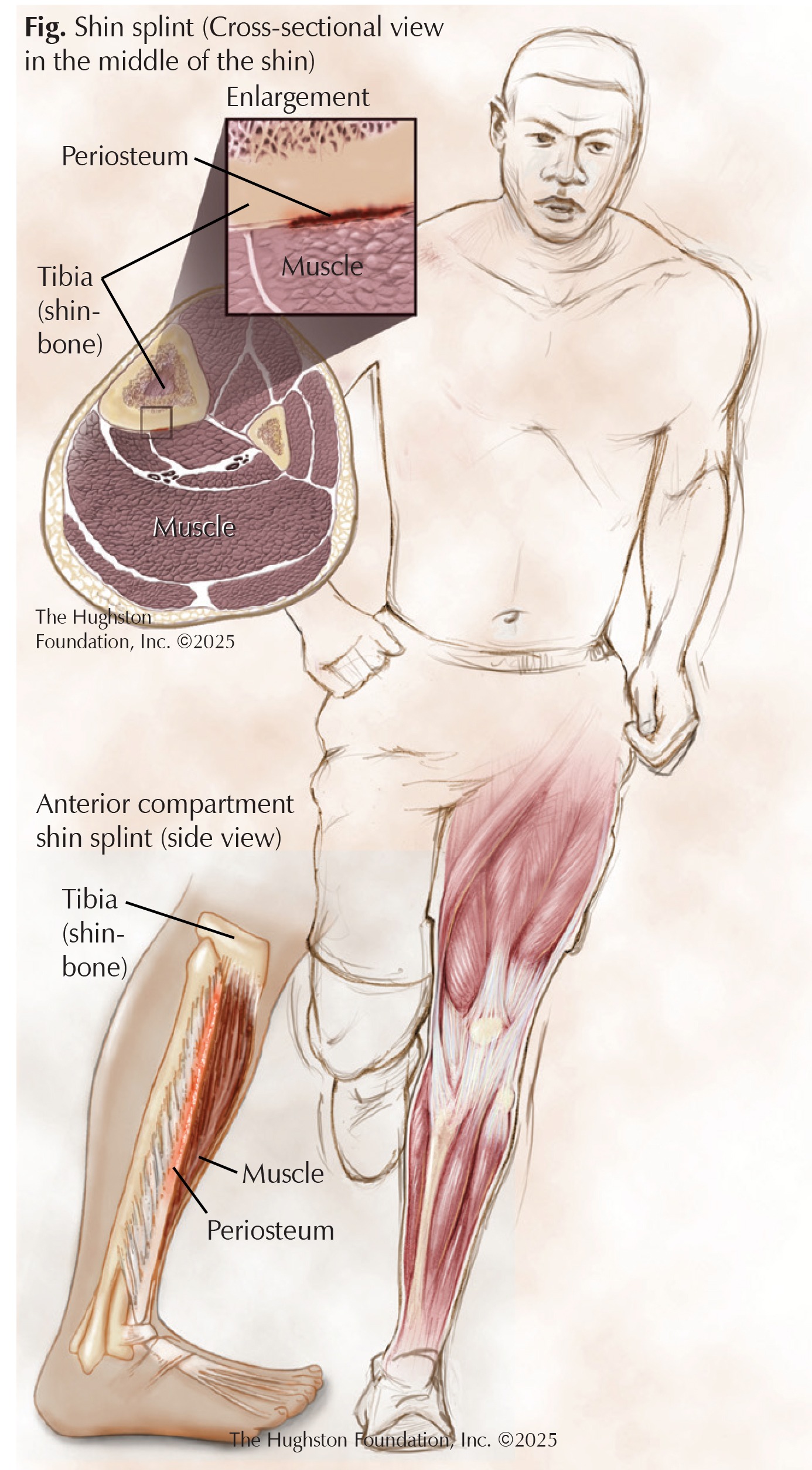 Shin Splints: Medial Tibial Stress Syndrome - Hughston Clinic